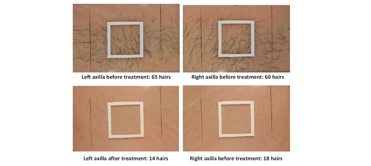 One‐year follow‐up results of hair removal using an 810 nm diode laser ...