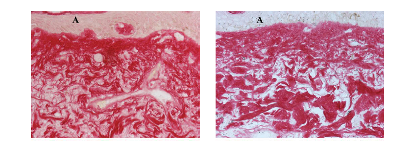 Split-face histological and biochemical evaluation of tightening effic