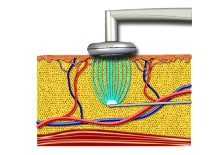 Bipolar RF as an Adjunct to Face and Body Contouring I InMode