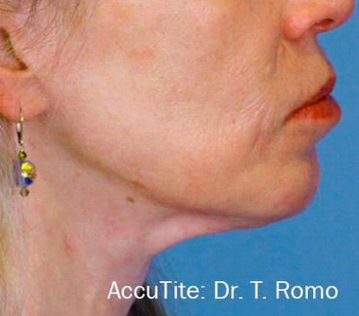 AccuTite | High Precision Minimally Invasive Treatment | InMode