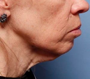 AccuTite | High Precision Minimally Invasive Treatment | InMode